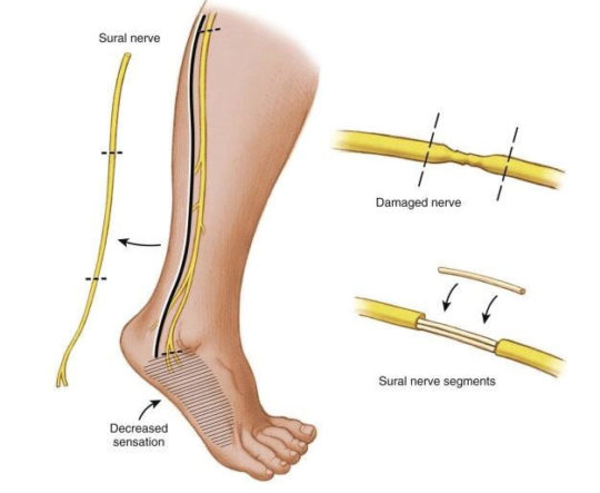 Peripheral Neuropathy | Corrigan Podiatry